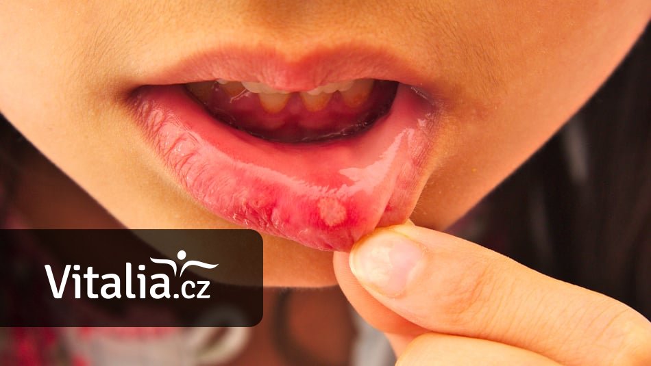 Za afty mohou plomby, rovnátka i nedostatek B12 - Vitalia.cz