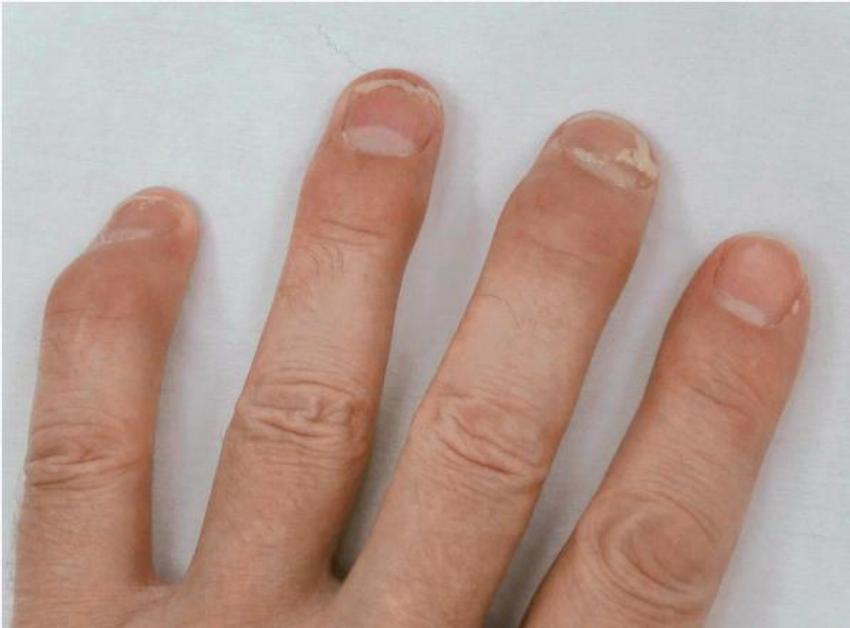 Psoriatická artritida - Zdraví.euro.cz