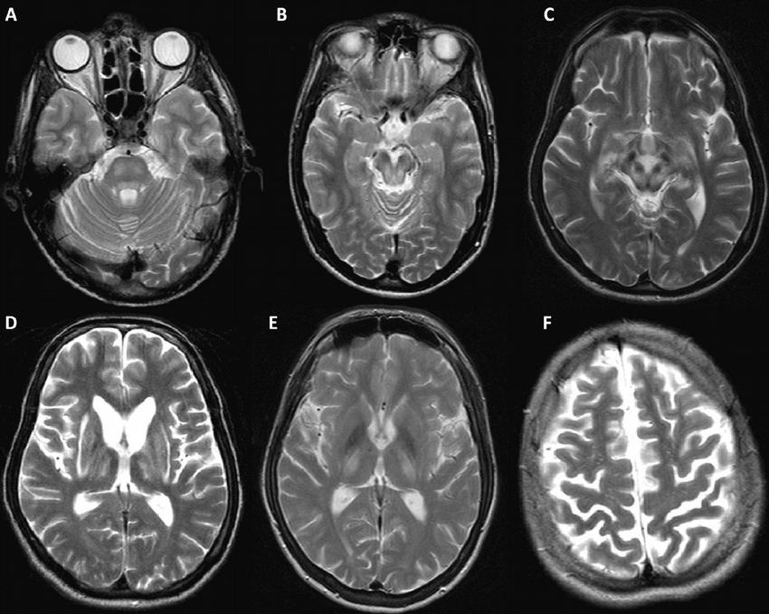 Neurologická forma Wilsonovy nemoci - Zdraví.euro.cz
