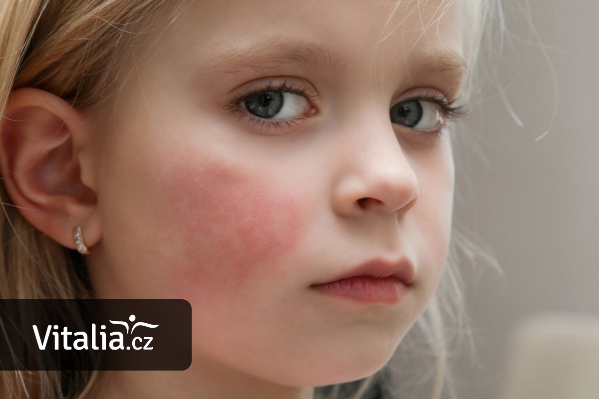 Děti trápí vyrážky a teploty. Pátá nemoc je na nebývalém vzestupu ...