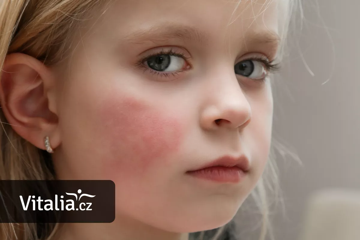 Děti trápí vyrážky a teploty. Pátá nemoc je na nebývalém vzestupu - Vitalia.cz
