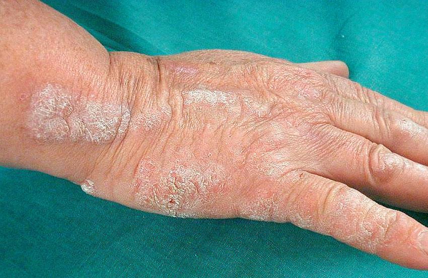 Lichenoidní dermatózy - Zdraví.euro.cz