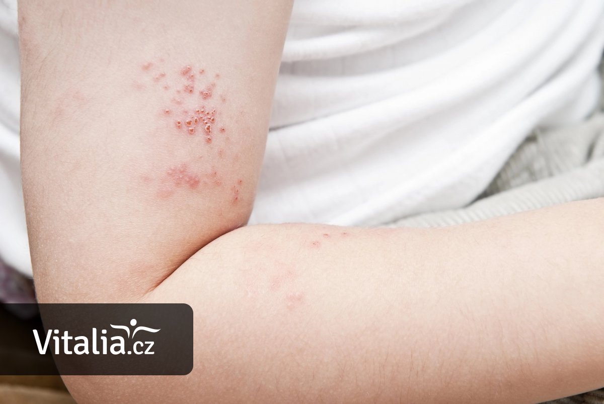 Nebezpečné mýty o pásovém oparu - Vitalia.cz