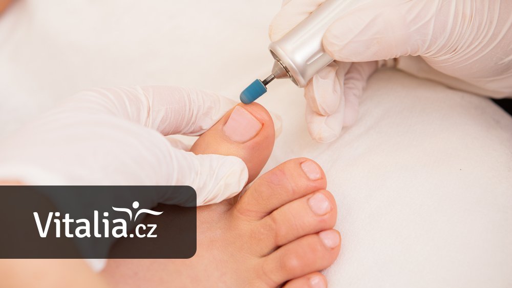 Zarostlý nehet: příčiny a jak ho vyléčit - Vitalia.cz