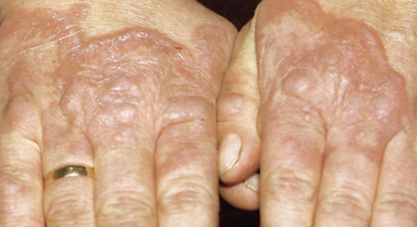 Nejčastější kožní projevy u diabetu mellitu - Zdraví.euro.cz