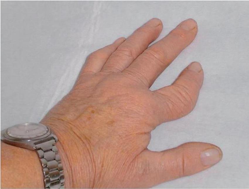 Psoriatická artritida - Zdraví.euro.cz