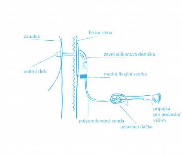 Ošetřování pacientů se stomií v domácí péči - Zdraví.euro.cz