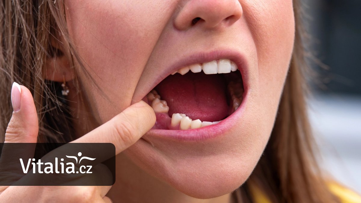 Chybějící zub může zubař nahradit jiným vaším zubem. Je to levnější než ...