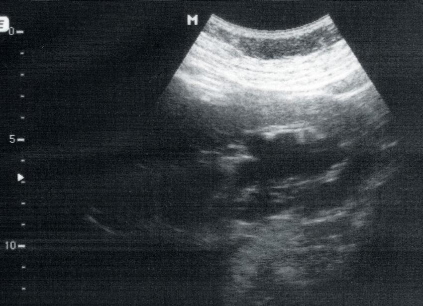 Uroinfekce v graviditě - Zdraví.euro.cz